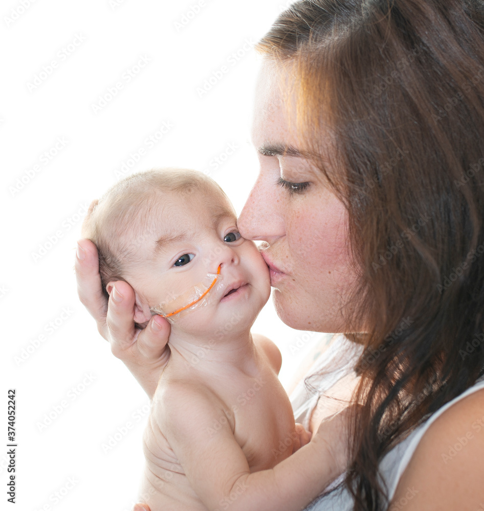 Mother holding kissing tiny special needs baby with nasogastric feeding ...