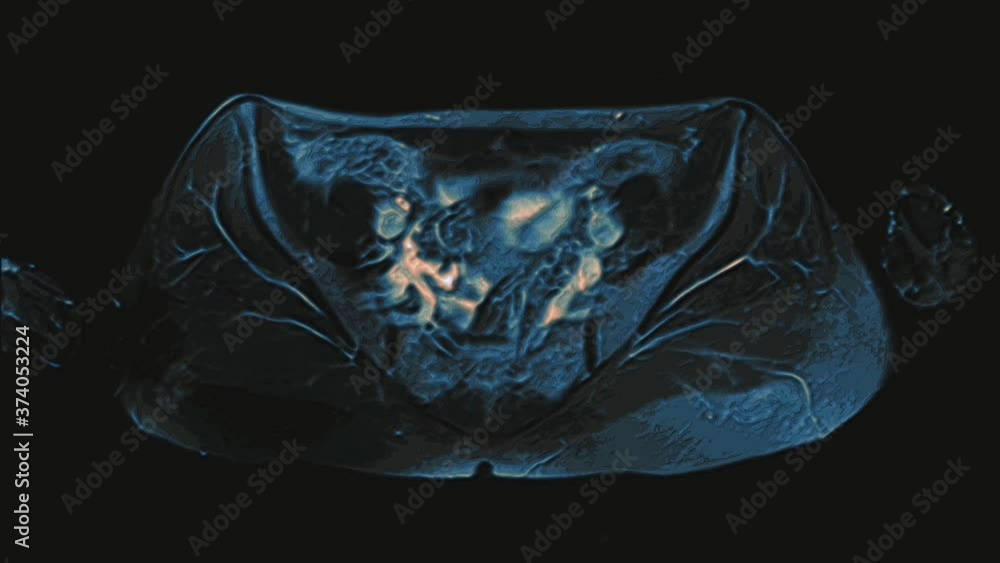 Bulk multicolored MRI of the female pelvic organs, abdominal cavity ...