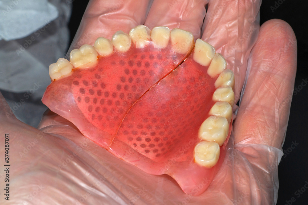 Removable denture with cast reinforcement on hand in gloves. Full upper ...
