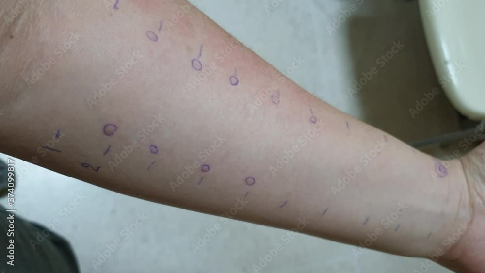 Arm showing food allergy skin prick test with rash sensitive reaction ...