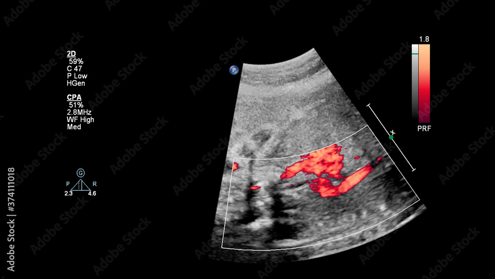 Ultrasound screen with fetal echocardiography. Stock Photo | Adobe Stock
