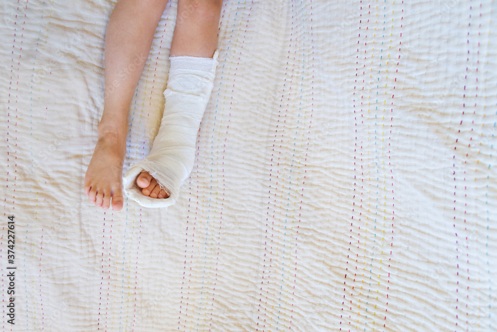 broken leg. Close-up of the cast on the feet. exercises to repair and ...