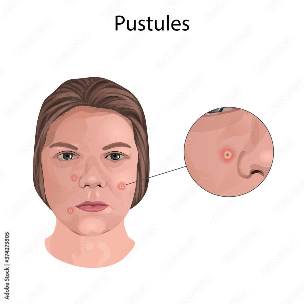 Acne. Pustules. Young woman face with skin inflammation. Close-up view ...