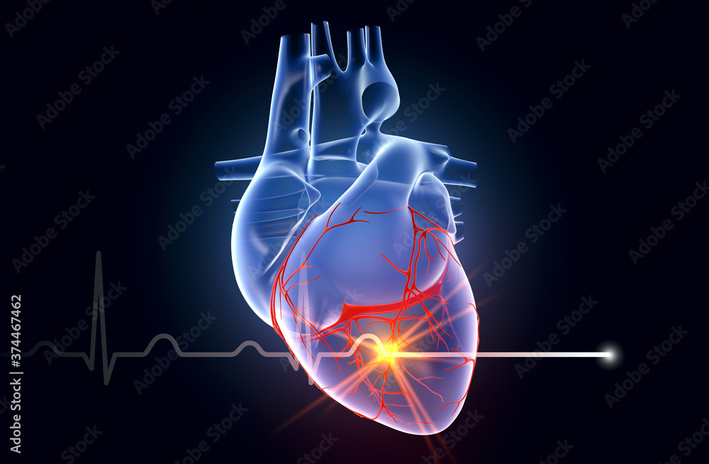 Cardiac infarction, myocardial infarction with ECG waves, medically ...