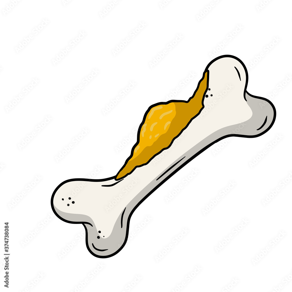 Bone cancer. Disease of the musculoskeletal system. Growth of harmful ...