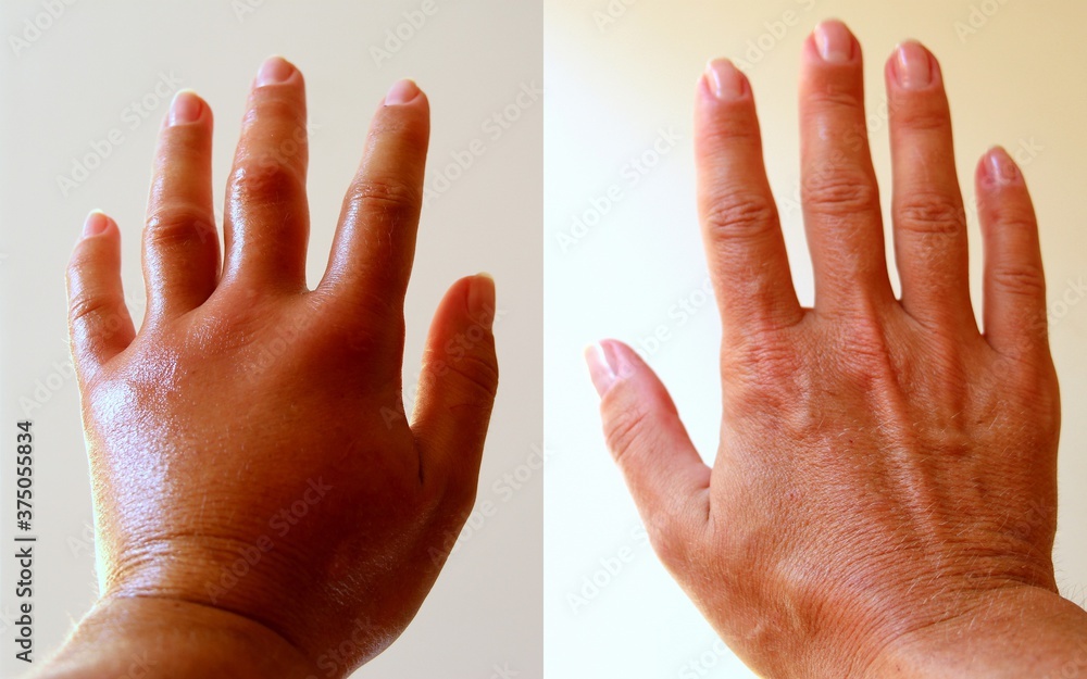 The left arm was severely swollen after a bee sting, which left its ...