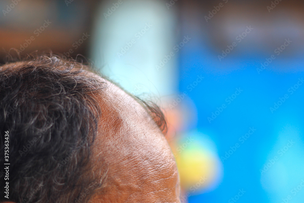 close up photo of a bald receding hairline of a male. hair loss male ...