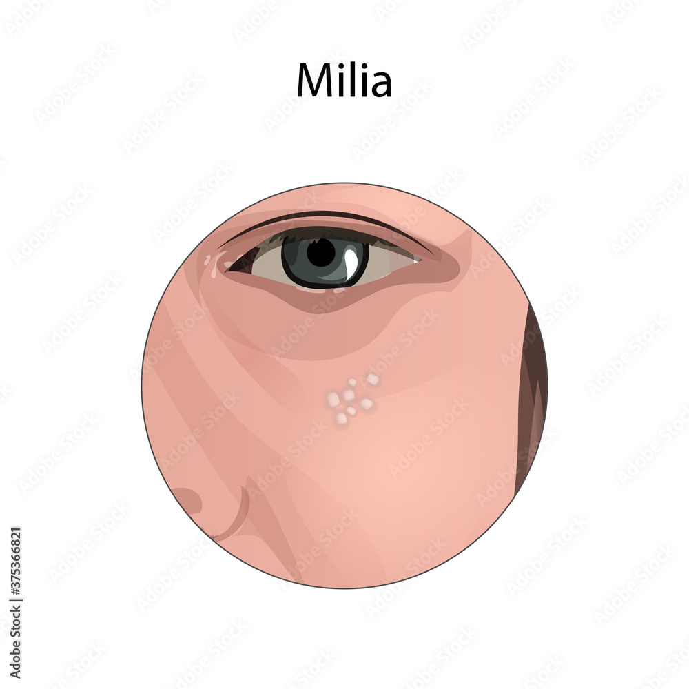 Acne. Milia. Young woman face with skin inflammation. Close-up view ...