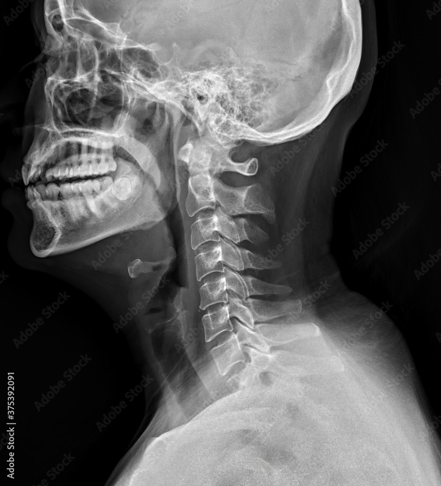 X-ray of cervical spine in lateral position Stock Photo | Adobe Stock