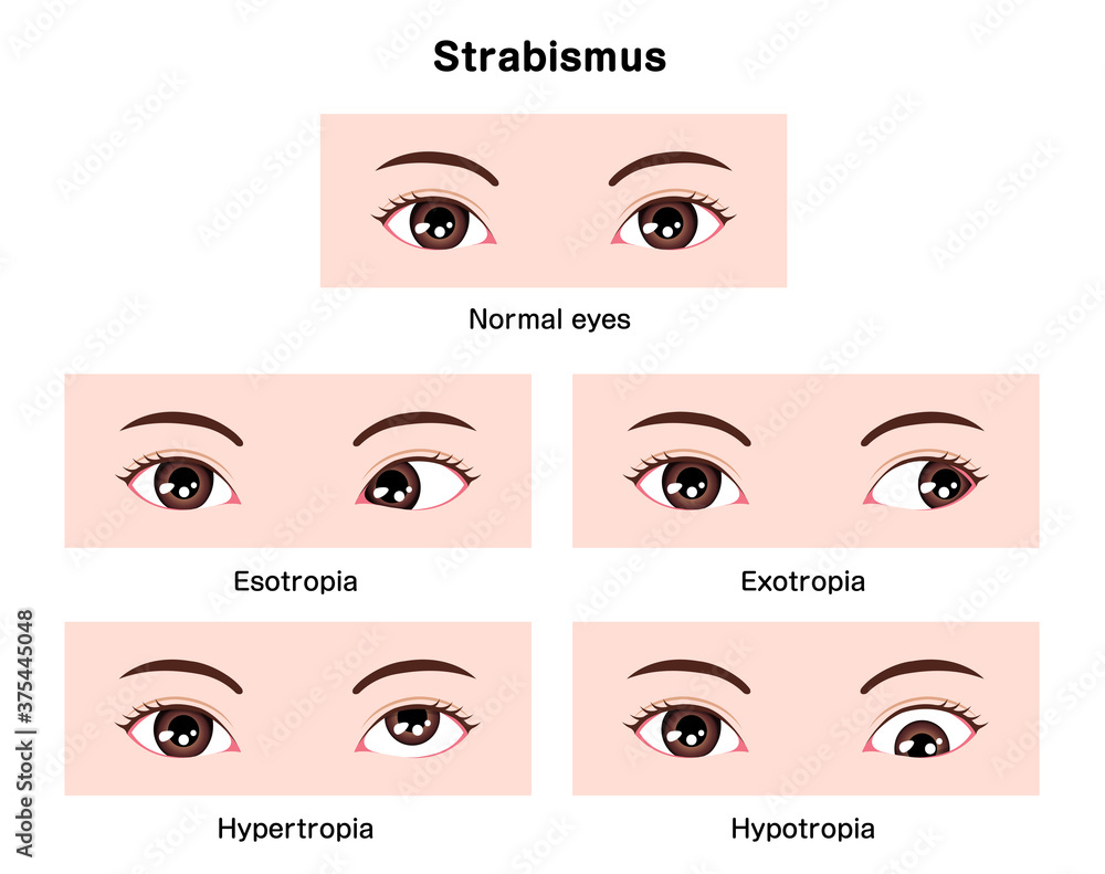 Plakát Types of strabismus vector illustration – Obraz na Zeď | Posters.cz