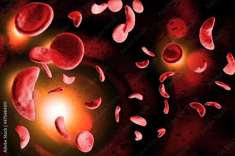 Sickle Cell Anemia 3D Illustration Stock Illustration | Adobe Stock
