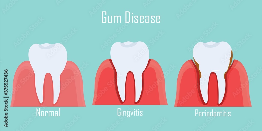 Póster Teeth infographic Gum disease stages gingivitis and ...