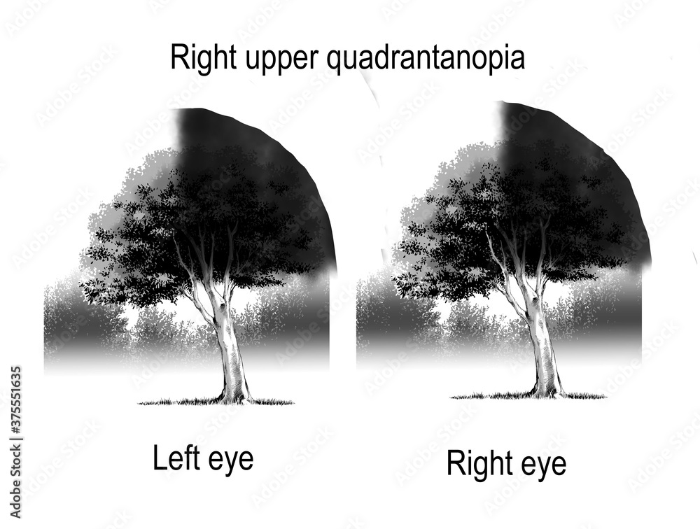 patterns of visual field defects are sign and symtomp of loss of vision ...