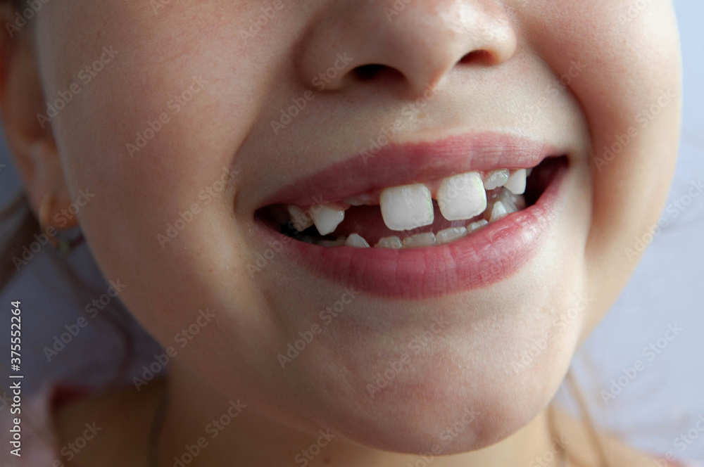 the girl smiles in close-up. there is no tooth at the top, and the ...