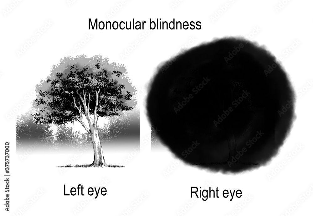 patterns of visual field defects are sign and symtomp of loss of vision ...