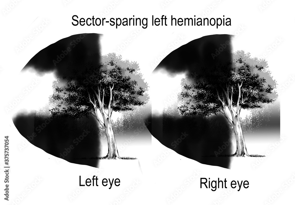 patterns of visual field defects are sign and symtomp of loss of vision ...