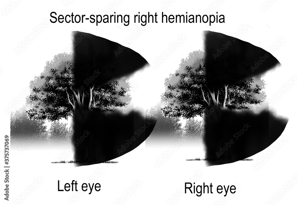 patterns of visual field defects are sign and symtomp of loss of vision ...