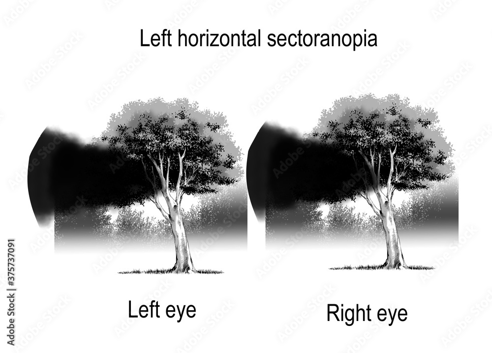 Patterns Of Visual Field Defects Are Sign And Symtomp Of Loss Of Vision Patterns Of Visual Field Defects Are Sign And Symtomp Of Loss Of Vision