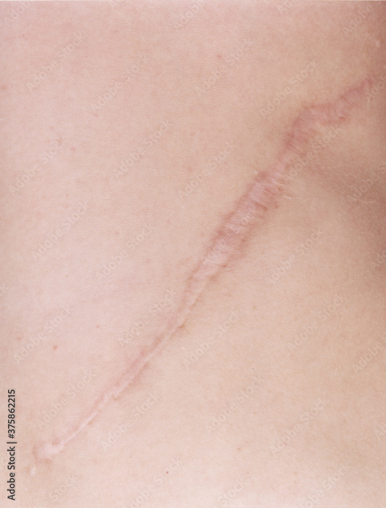 Scar Stock Photo | Adobe Stock