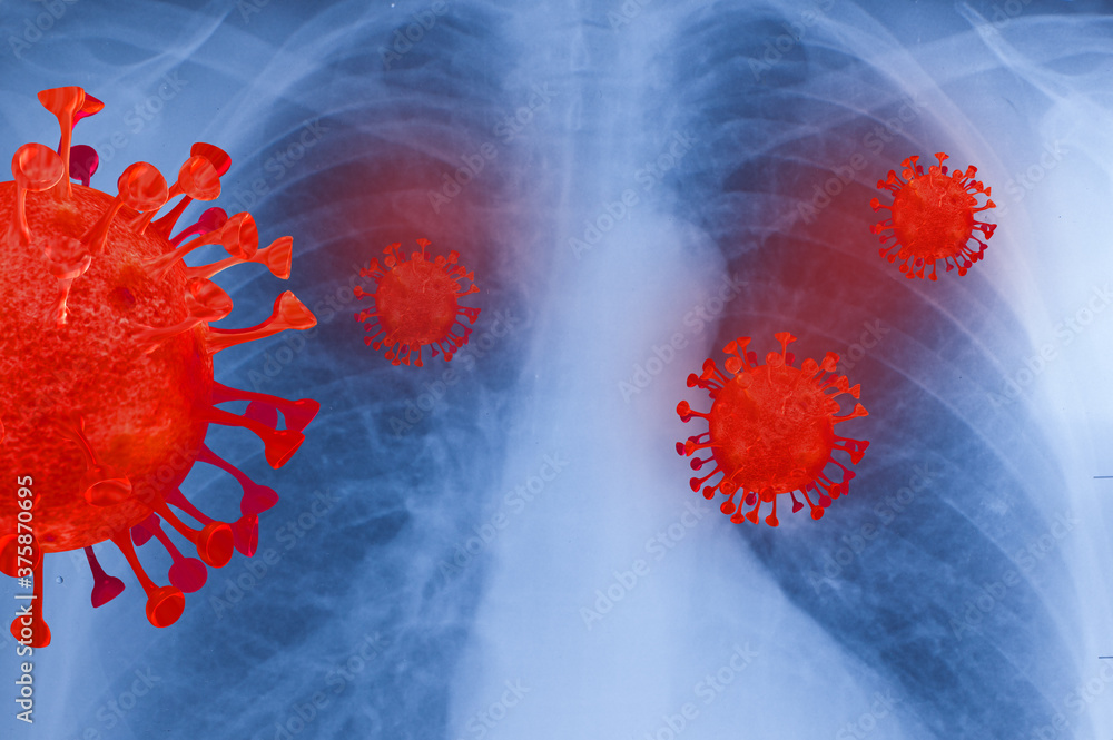 Chest X-RAY with lung injury from corona virus. Concept xray film lungs. Stock Illustration ...