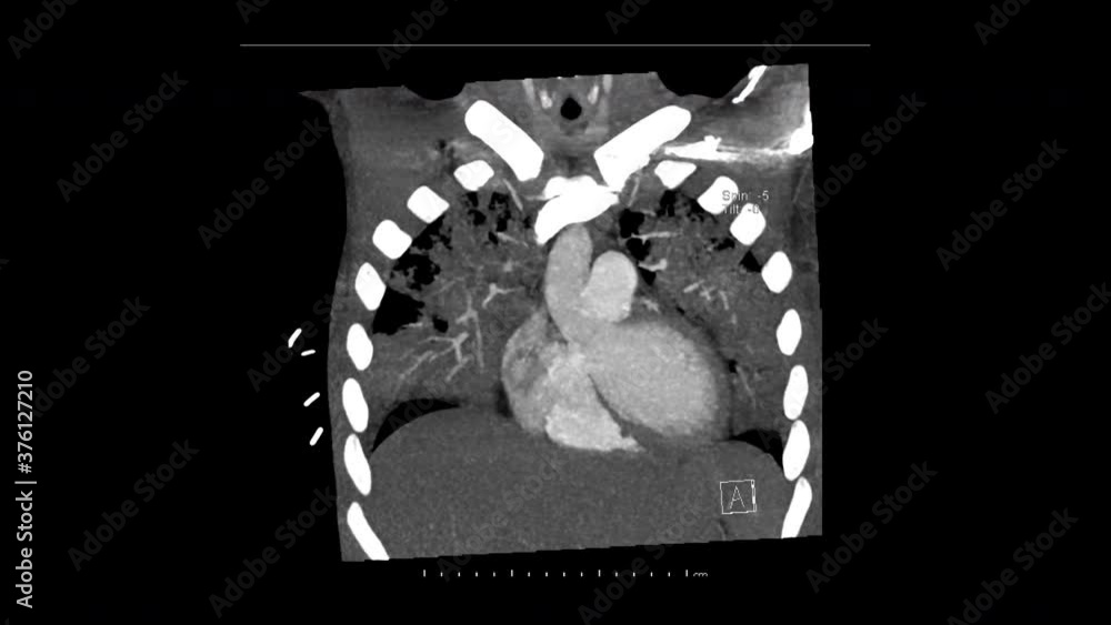 Computed Tomography of the pulmonary artery in coronal plane for ...