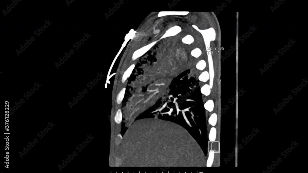 Computed Tomography of the pulmonary artery in Sagittal plane for ...
