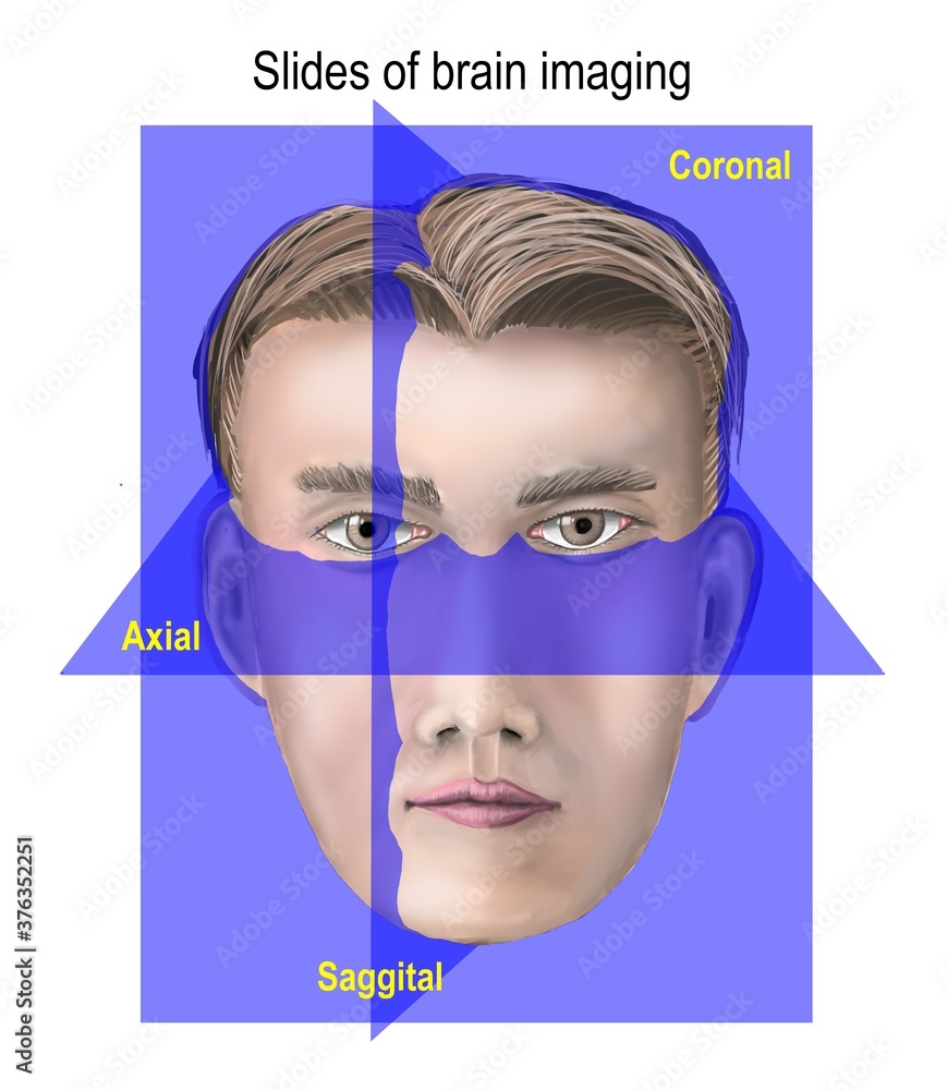 the difference slides of brain imaging regarding to CT and MRI images ...
