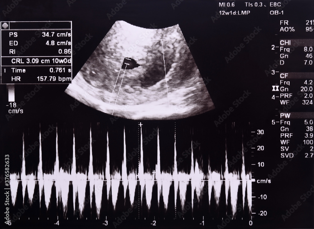 Ultrasound of Fetus - measuring heart baby rate Stock Photo | Adobe Stock