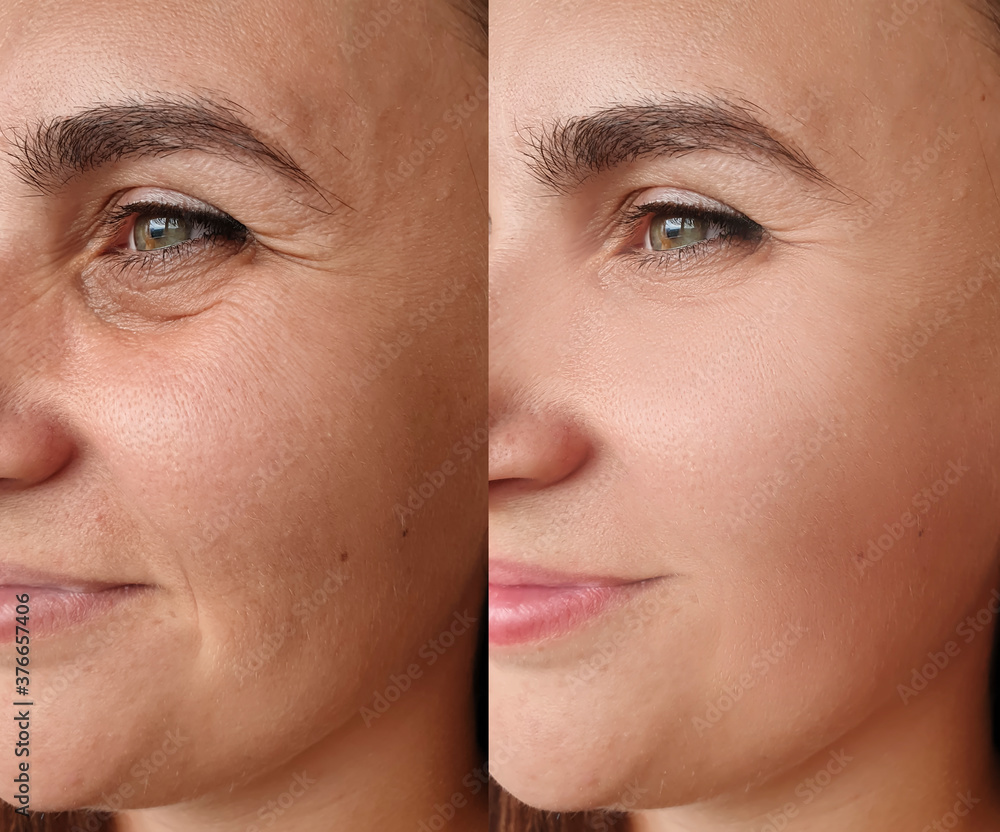 woman face wrinkles before and after treatment collage Stock Photo ...