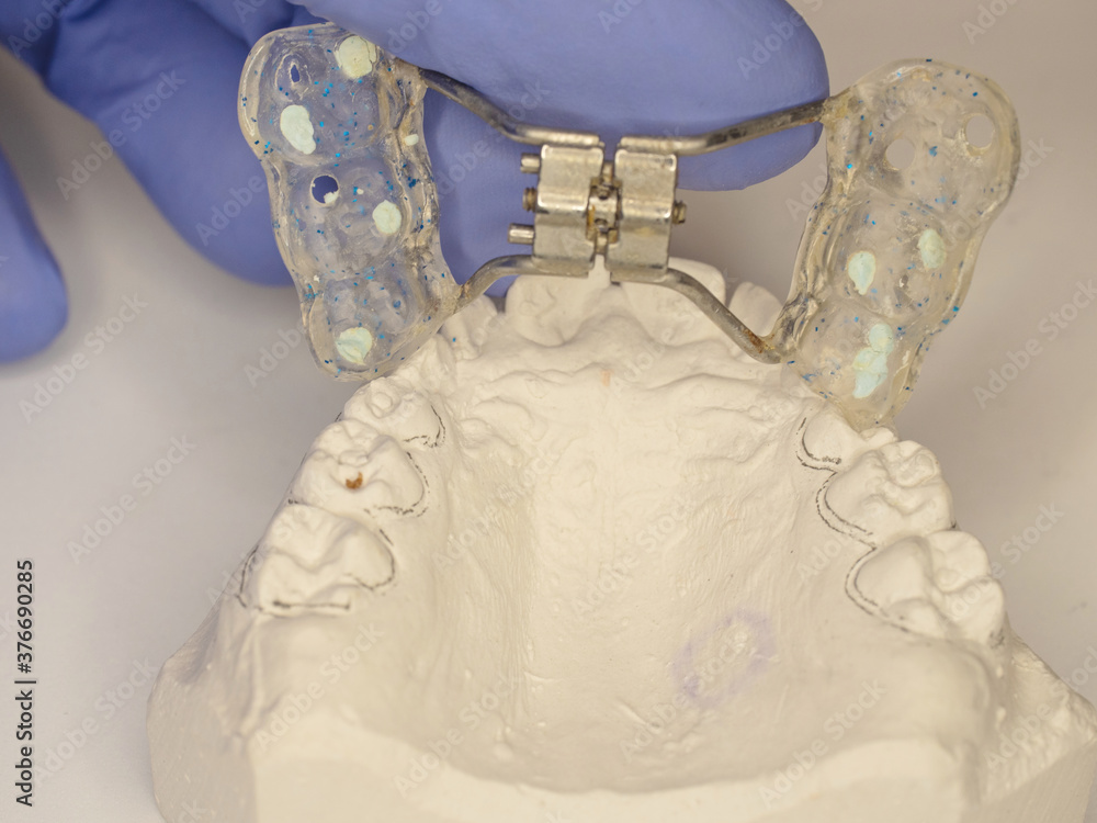 Orthodontic cast of jaw with brace construction. Hyrax braces on ...