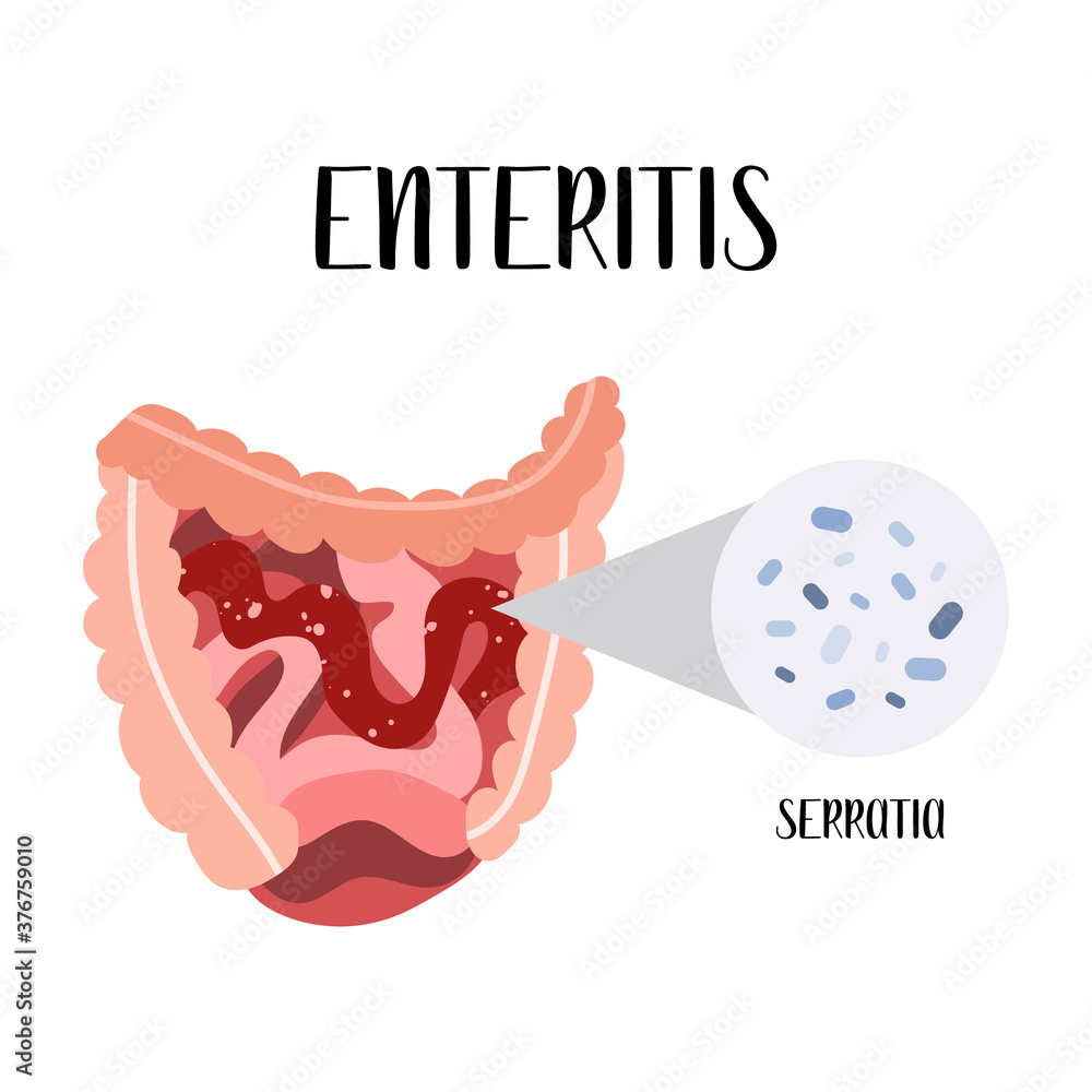 Enteritis, inflammation of the small intestine. Serratia bacteria. Gut ...