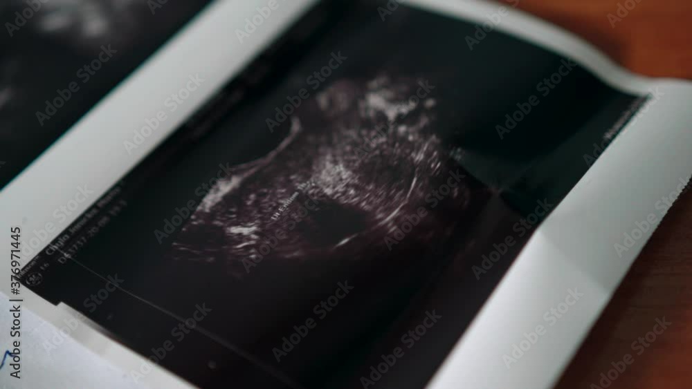 Ultrasound pregnancy fertility scan image in medical clinic dolly right ...