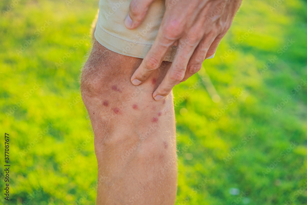 Legs with many red spot and scar from insect bites. Mosquitos allergy ...
