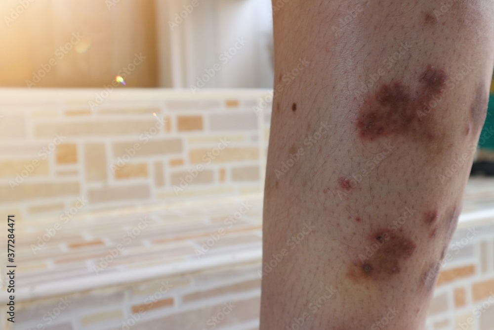 Dry skin on the legs, psoriasis rashes, eczema, and other skin ...