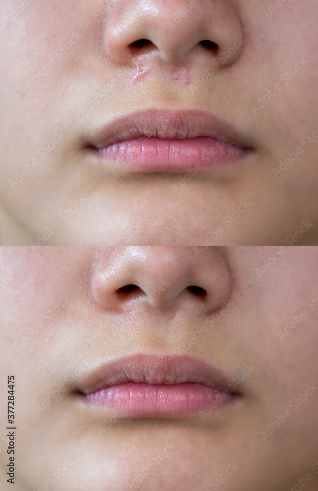 Image before and after laser treatment of keloid scar caused by ...