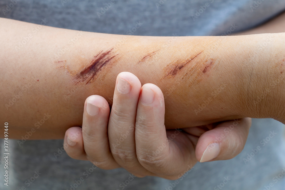The wound form scabs on hand and arm. The wound happen during woman ...