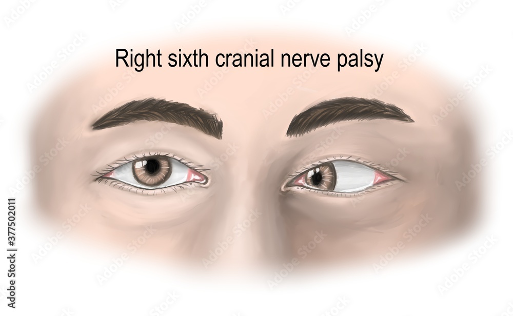 right abducen nerve palsy presents with lateral rectus palsy. Stock ...