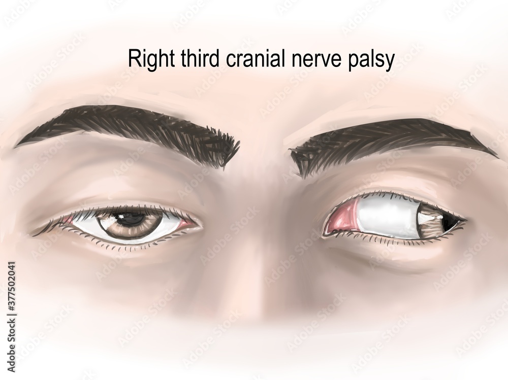 Poster right third cranial nerve palsy was demonstrated with medial ...