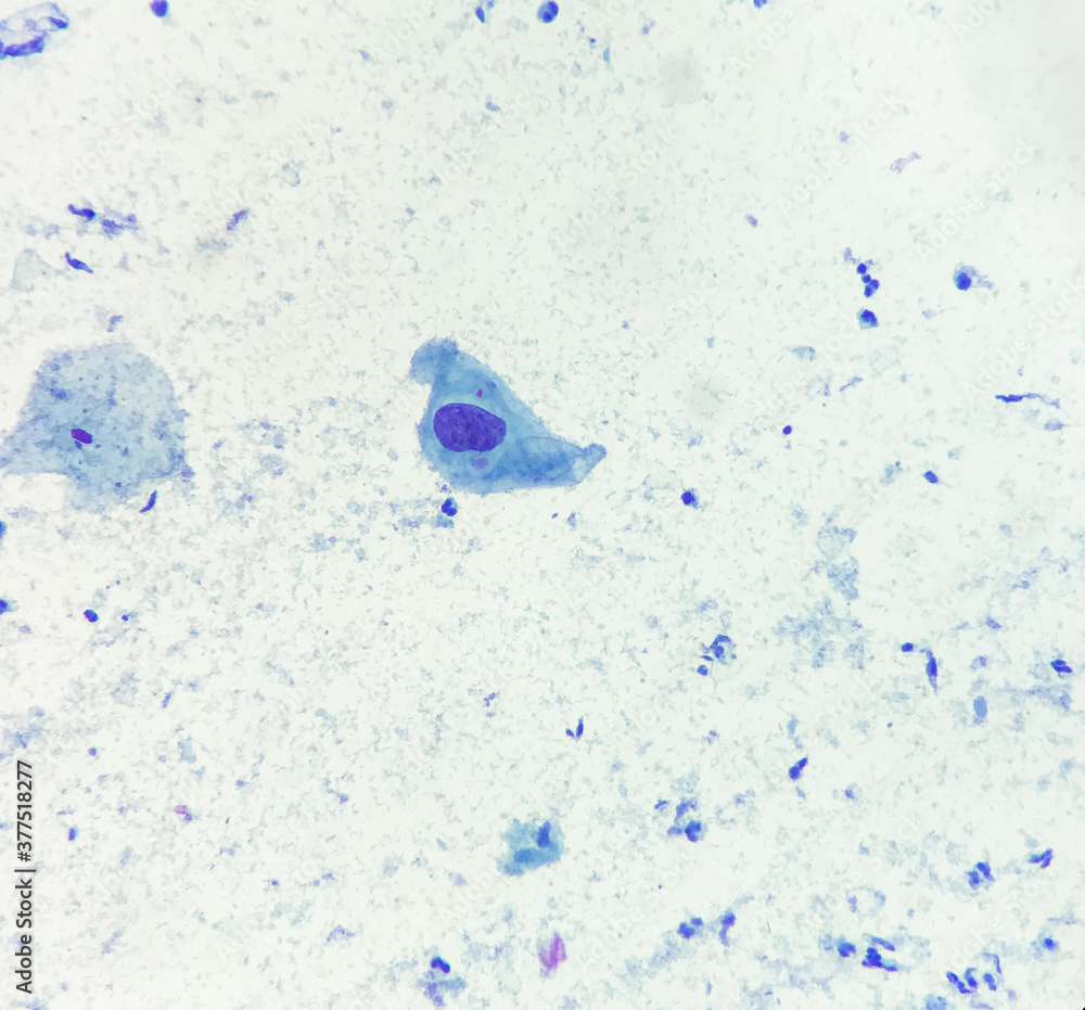 Photo of Low grade squamous intraepithelial lesion (LSIL), showing ...