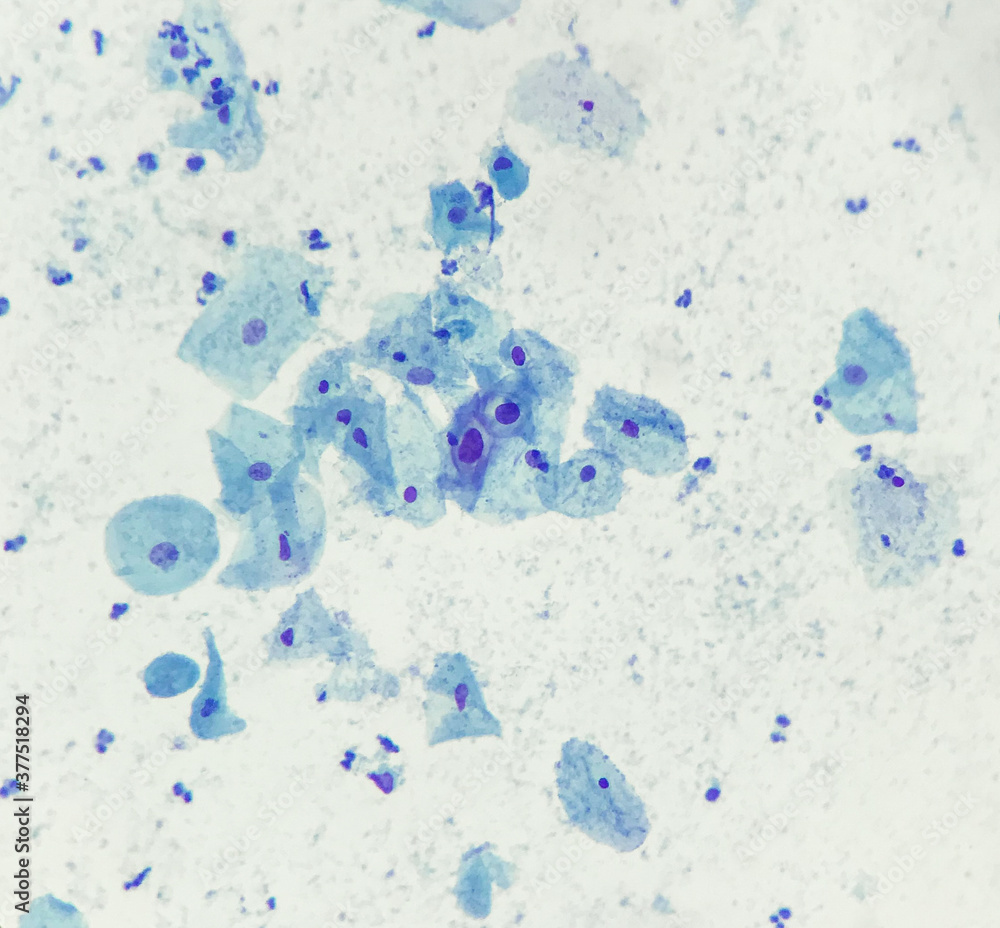 Foto de Photo of Low grade squamous intraepithelial lesion (LSIL ...