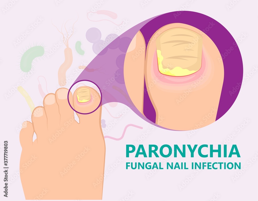 Vetor do Stock: skin finger nail toes symptom injuries pus drain ...