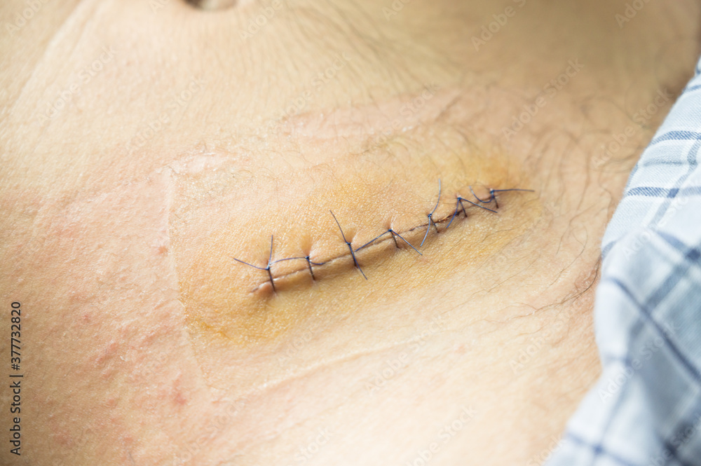 Photo & Art Print Nurse or Doctor hand treating the wound patient to ...