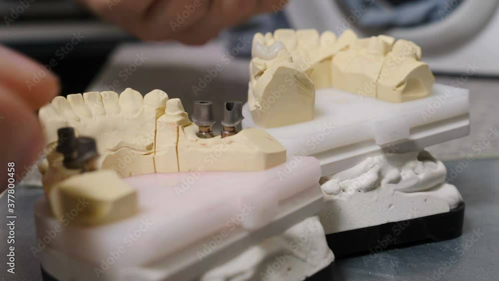 Dental prosthesis, artificial tooth, prosthetic. Male hands setting ...
