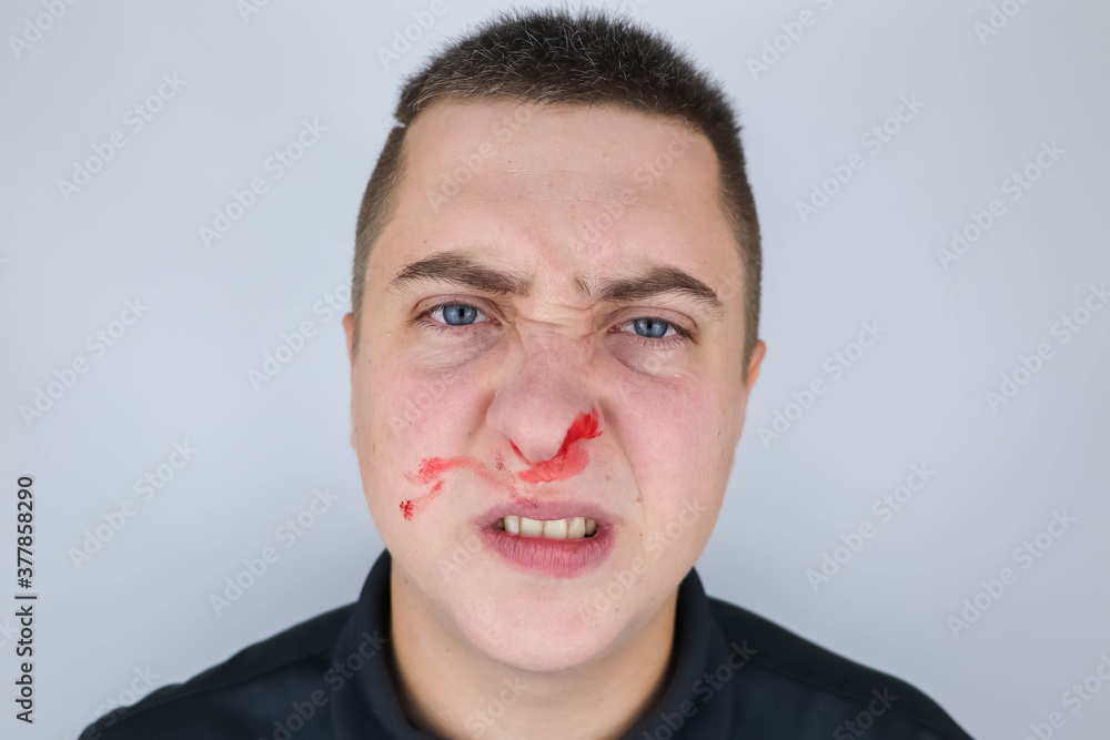 The man has a broken nose after a fight. Blood on hands, cheeks and ...