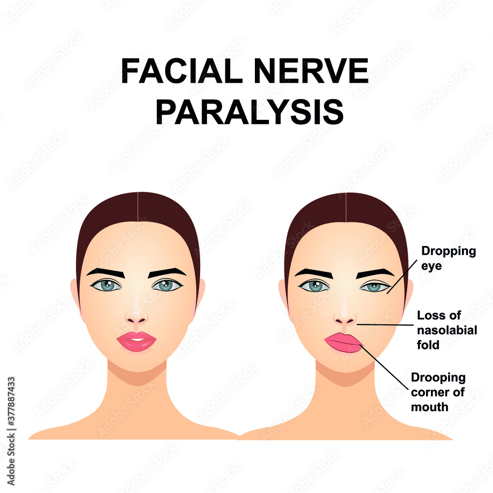Paralysis of the facial nerve. Bell's palsy. Stock Vector | Adobe Stock