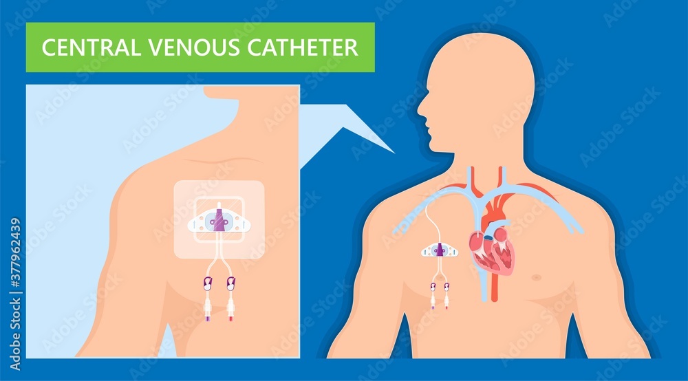 Central venous catheter CVC PICC line peripherally inserted access large vein medication fluid ...