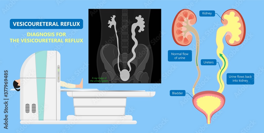 kidney damage UTI scan test tube VCUG acute VUR cyst exam flow pain ...