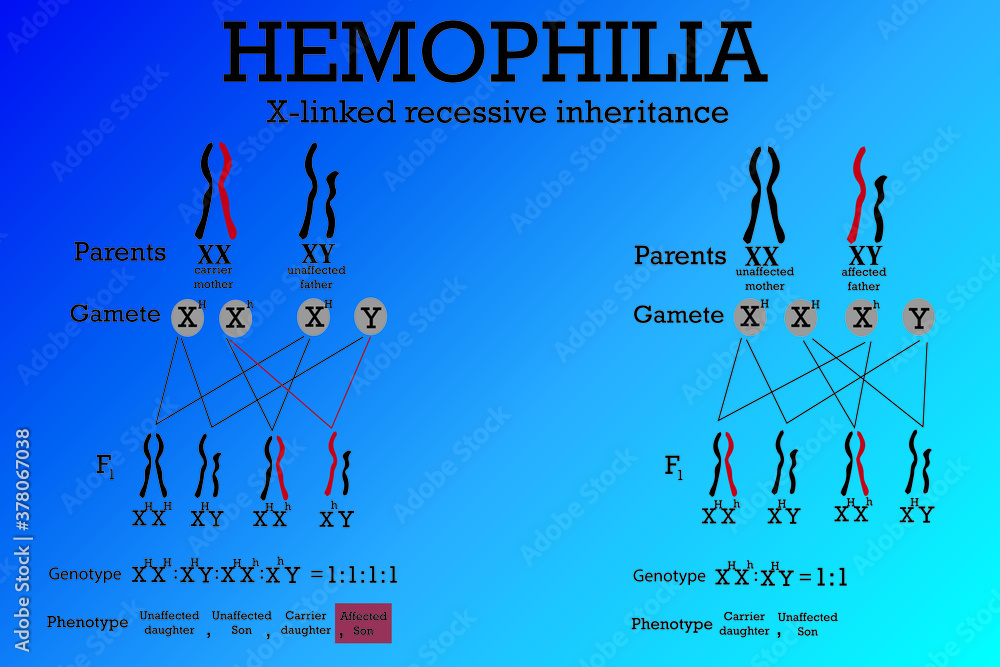 Hemophilia is a genetic disorder which blood doesn't clot normally because it lacks sufficient ...