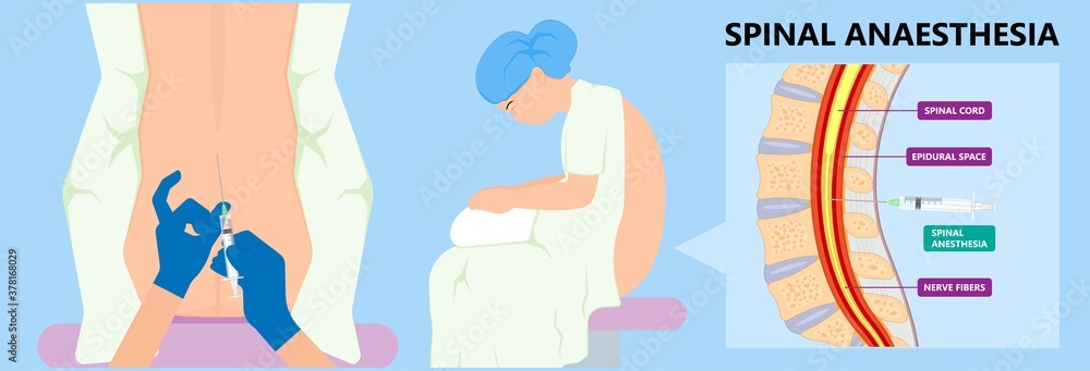 Epidural spinal block anaesthesia Pinched relieve General vaginal ...