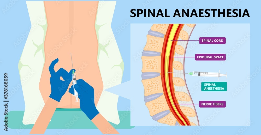 Epidural spinal block anaesthesia Pinched relieve General vaginal ...